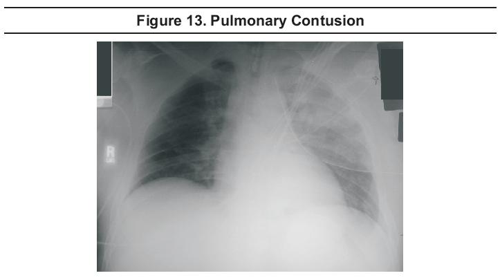 An Evidence Based Thoracic Imaging Curriculum for Emergency Medicine